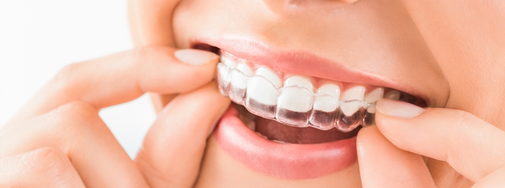 Dental Orthodontic Retainers at Advanced Dental