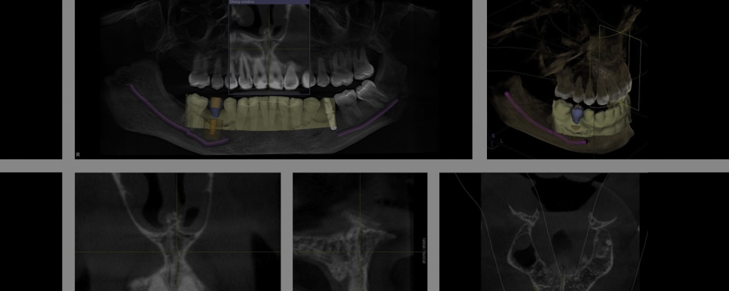 Bone Graft and Implant | Advanced Dental